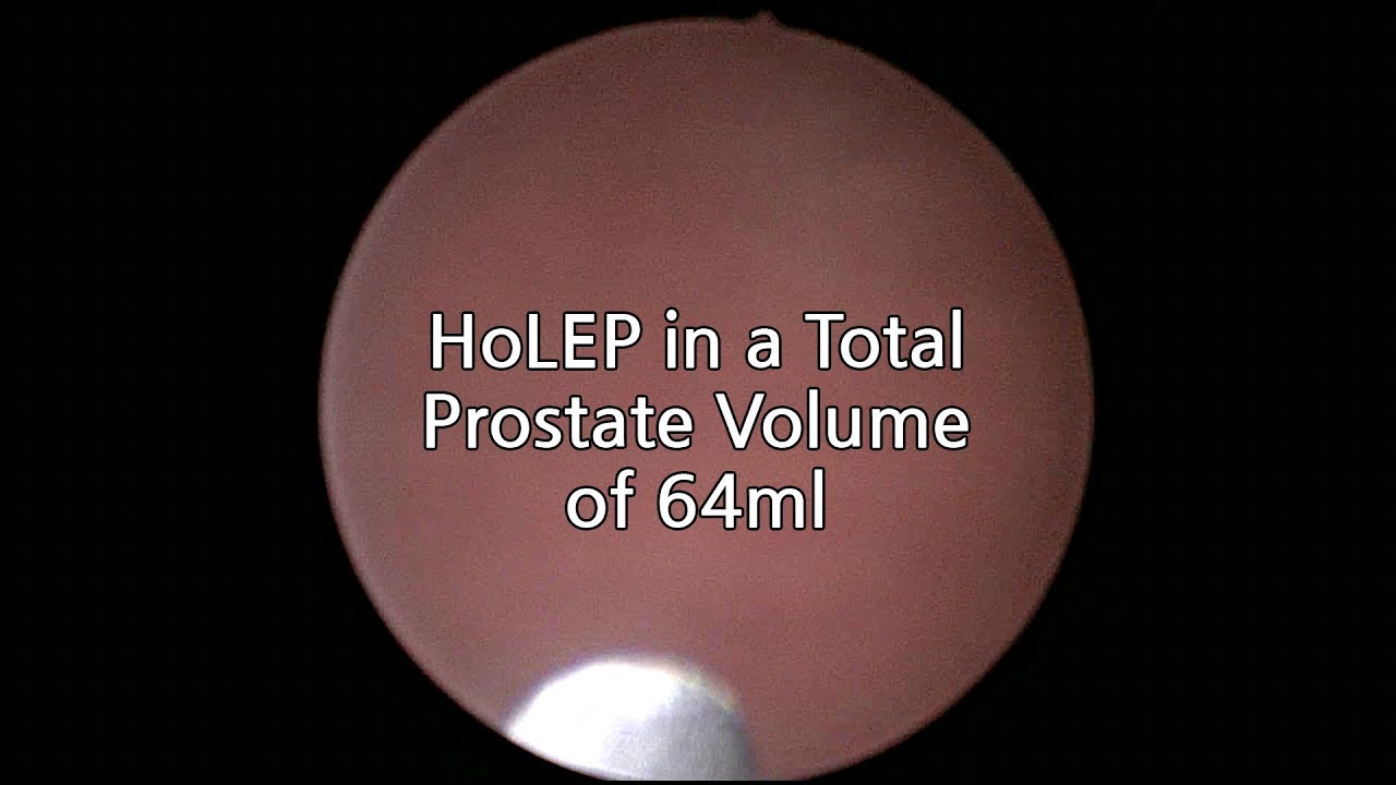 Routine HoLEP Procedure with Dr. Oh (64ml) - YouTube