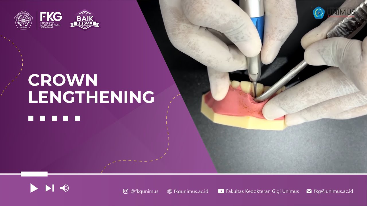 CROWN LENGTHENING - YouTube