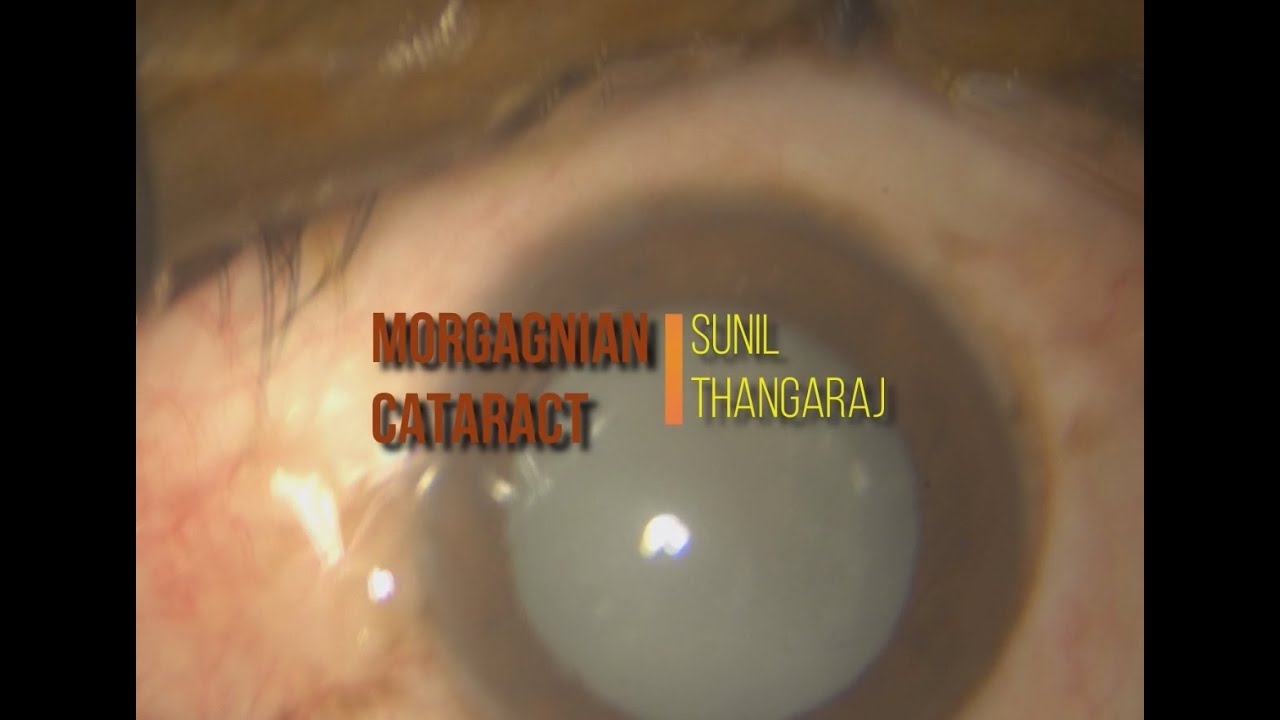 Phaco in a morgagnian cataract a few principles - YouTube