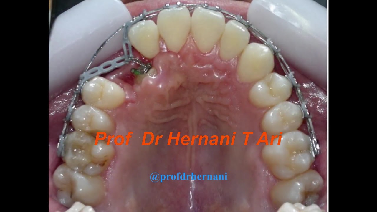 Ortodontia - Canino Incluso Tracionado - YouTube