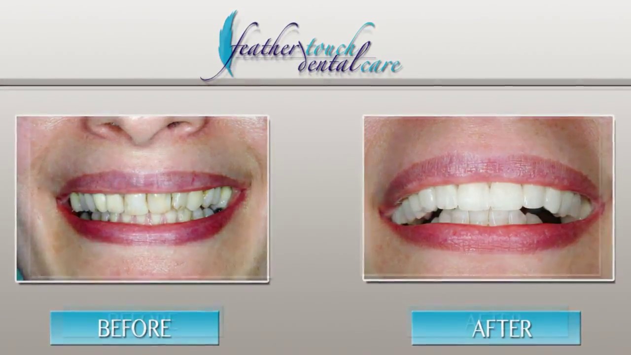 Smile Makeover from Feather Touch Dental Care in Atlanta - YouTube