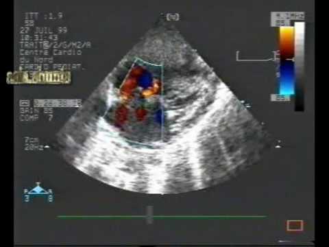 atrial septal aneurysm,multiple atrial shunts and vsd. - YouTube