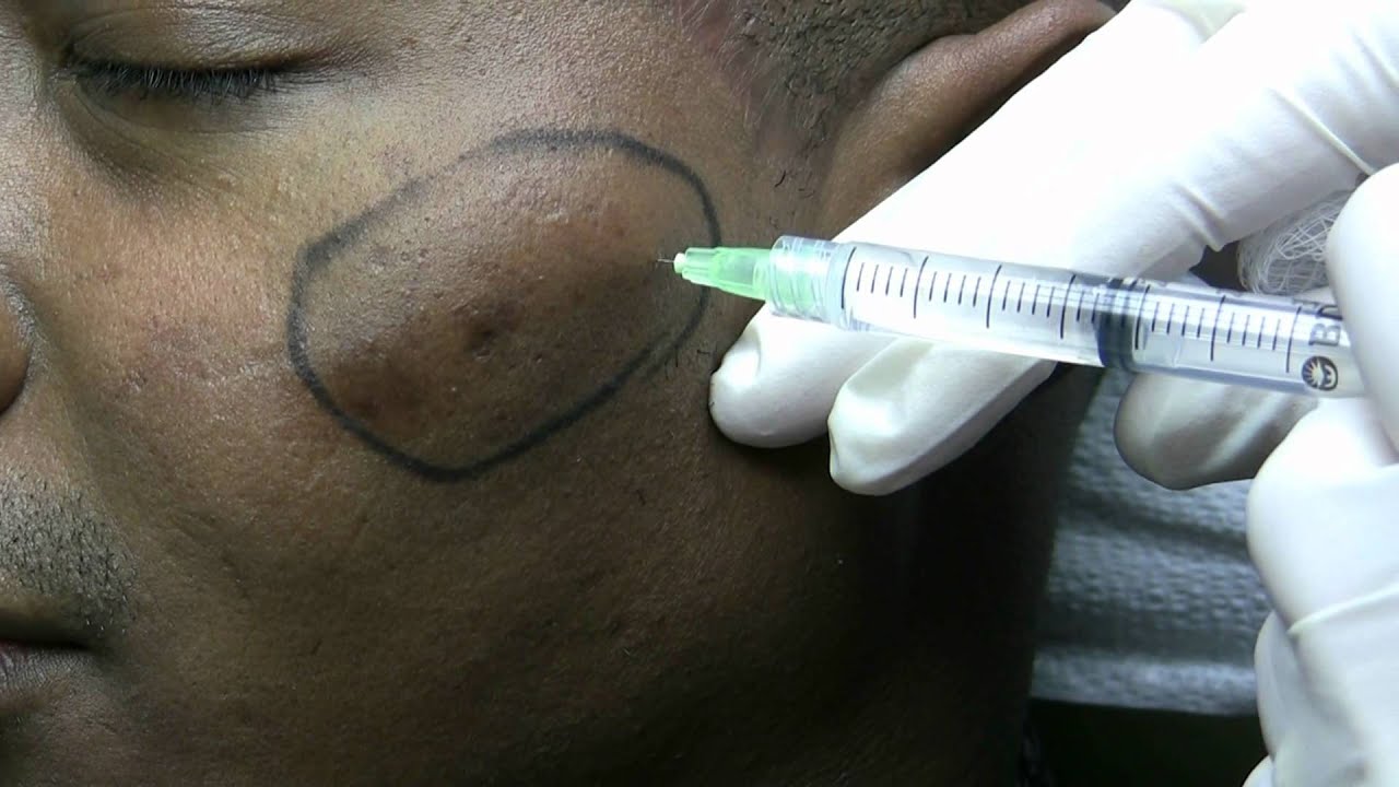 Dr. Joe Niamtu Injects Hyaluronidase to Dissolve Excess Cheek Filler ...