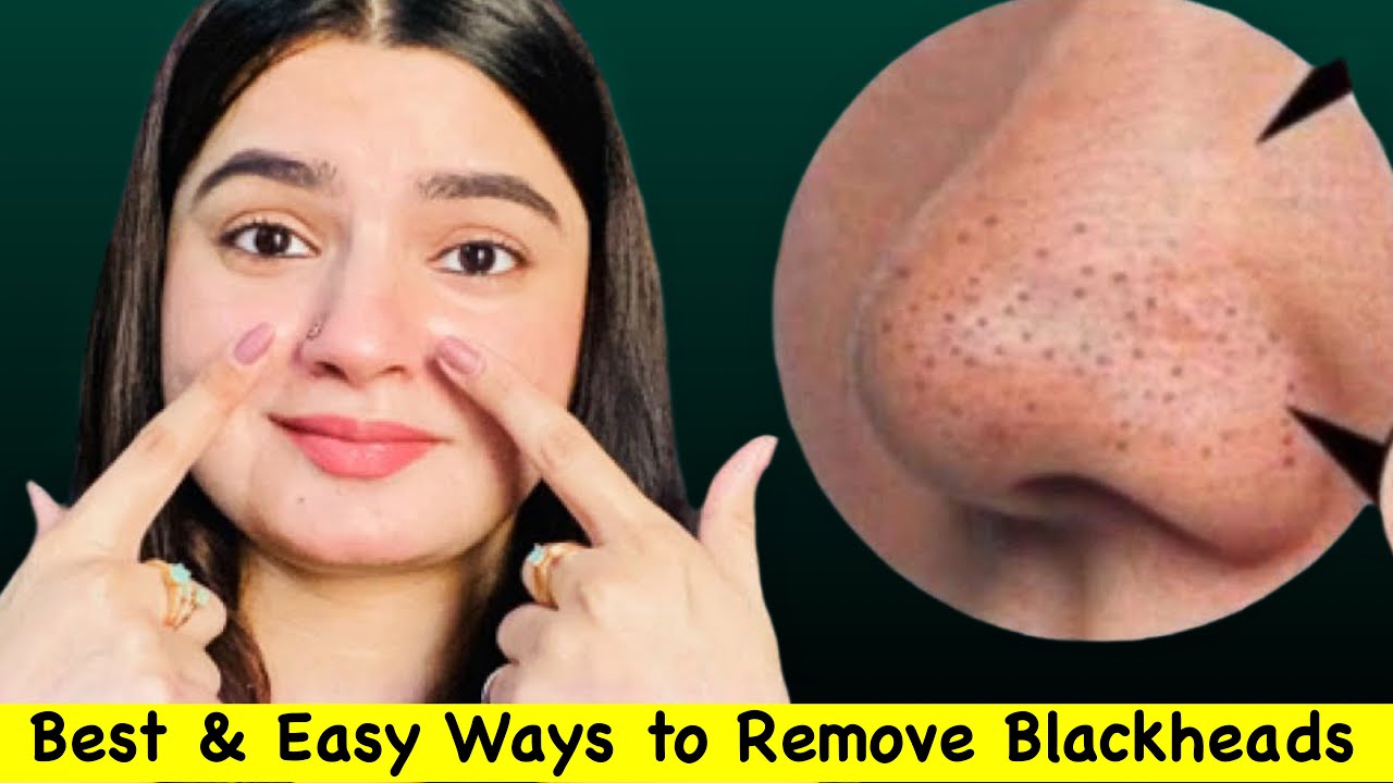Easy ways to REMOVE Blackheads At Home | Clear Skin - YouTube