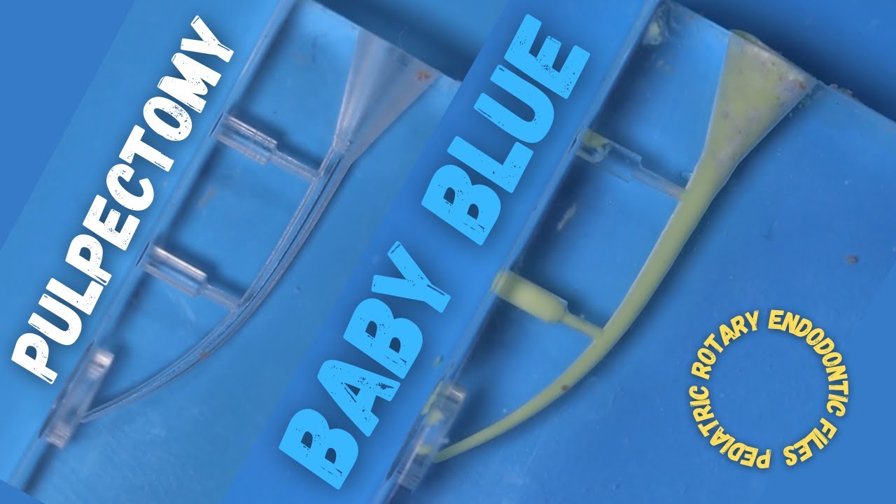 Pulpectomy with Baby Blue Files (an exclusive pediatric rotary ...
