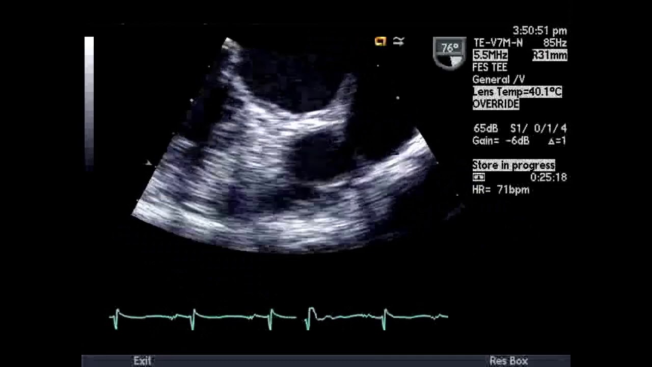 Scanning the Left Atrial Appendage with TEE - YouTube
