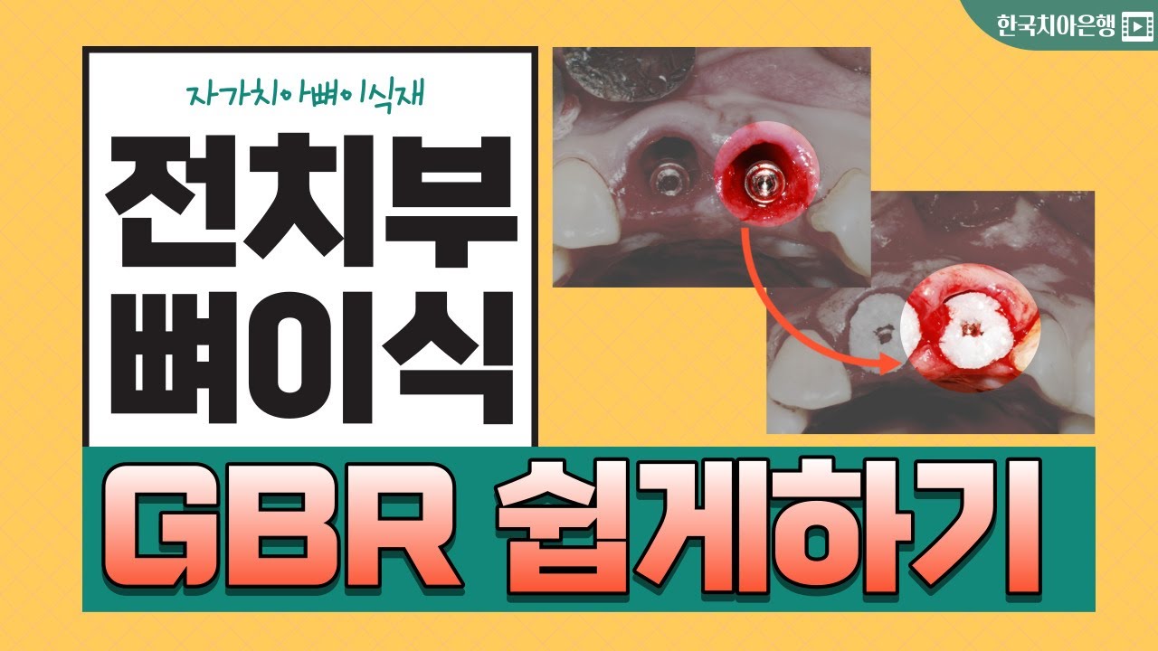 [한국치아은행] 110. 앞니 임플란트/Esthetic region, gingiva의 모양과 bone의 volume을 ...