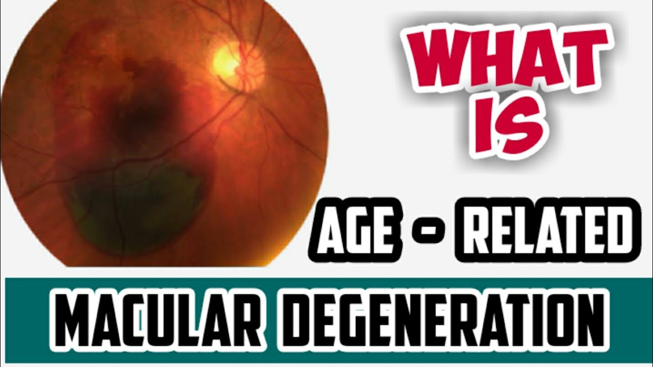 What is Age related Macular Degeneration | Optometry World - YouTube