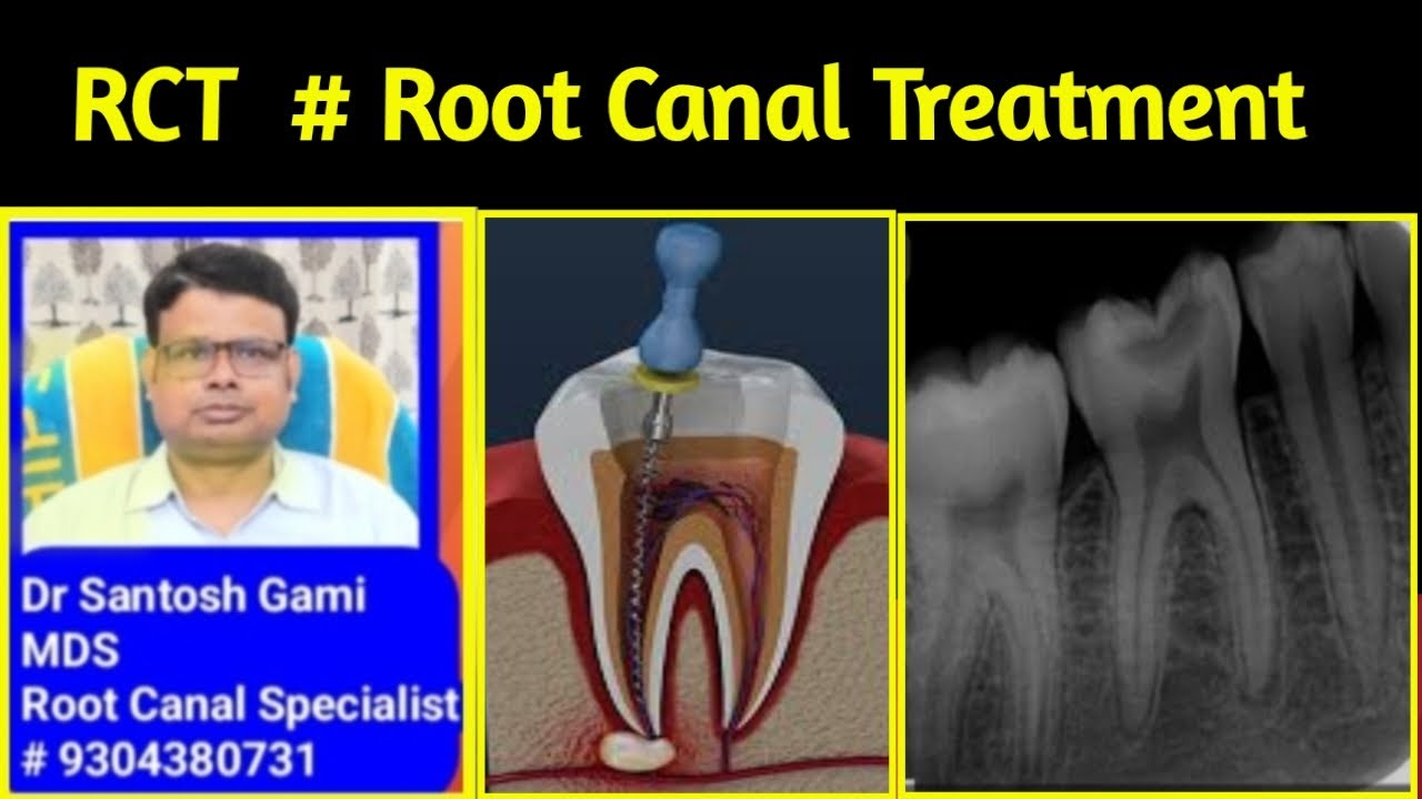 RCT a Safe Way to Save Teeth..... #Root Canal Treatment #RCT.... - YouTube
