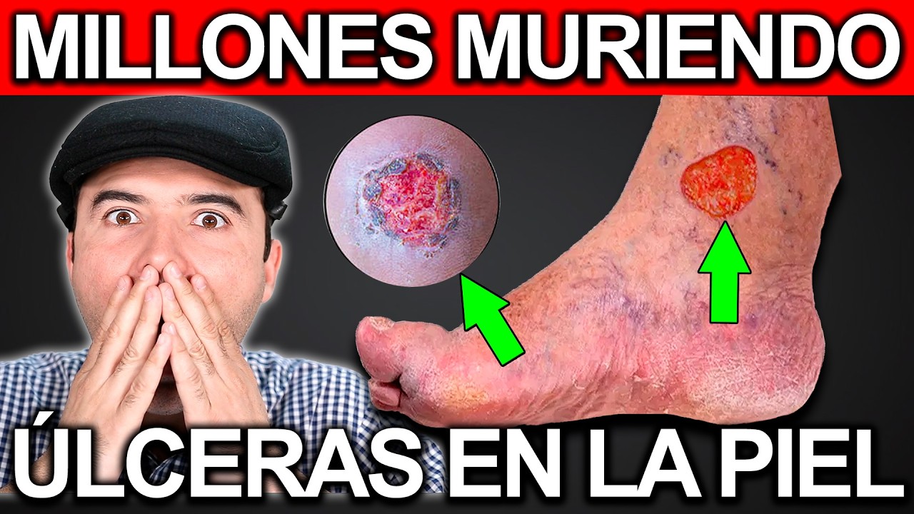 CÓMO CICATRIZAR ÚLCERAS de la PIEL Que NO MEJORAN | 5 Pasos Que ...