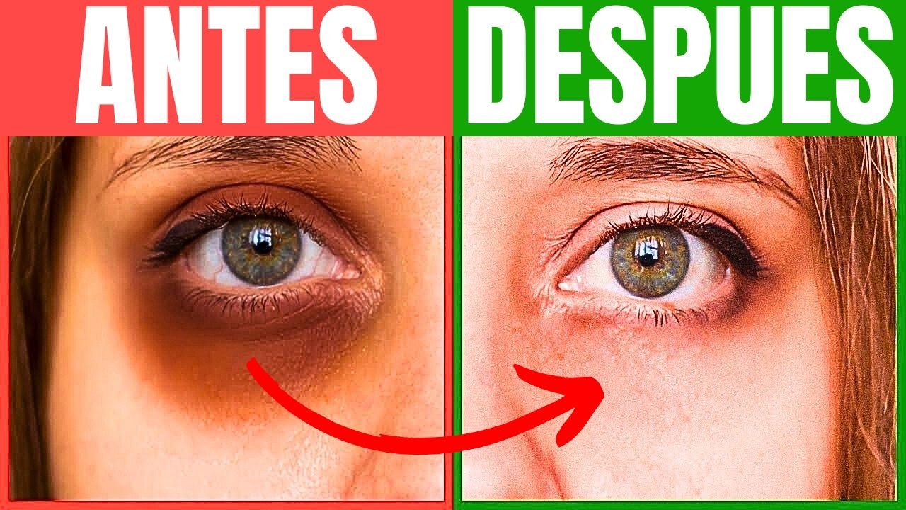 Descubre el Secreto para Deshacerte de las Ojeras y Bolsas con Solo 3 ...