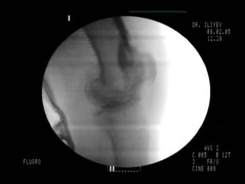 Video Arthrography - YouTube