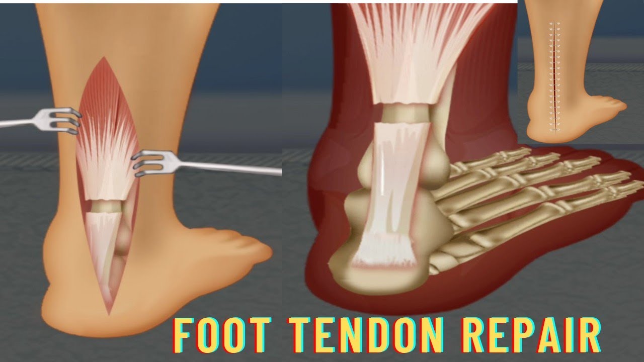 ASMR - Foot Tendon Repair | Animation asmr Surgery | - YouTube