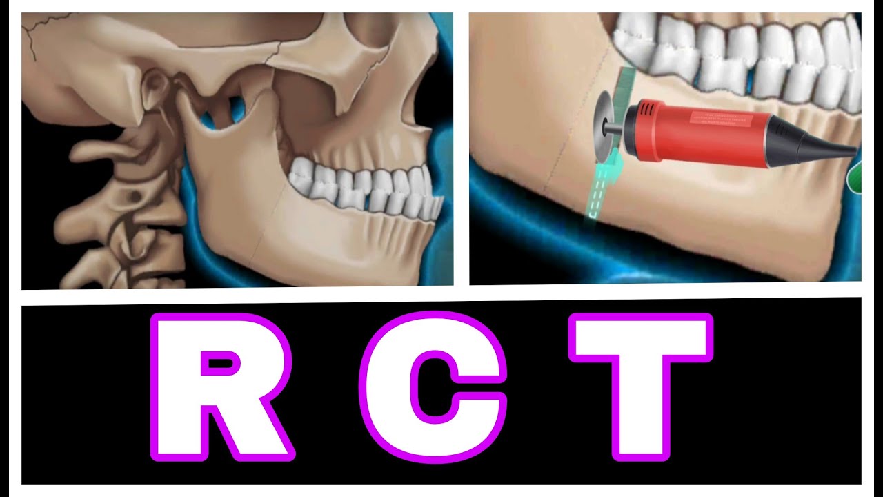 ASMR 🦷🦷 R C T for teeth surgery animation video // root canal - YouTube