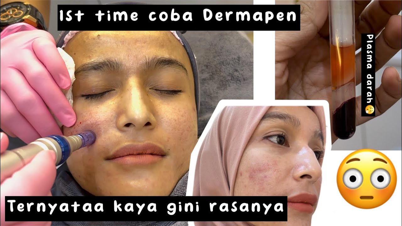 treatment dermapen penghilang bopeng - pakai plasma darah sendiri di ...
