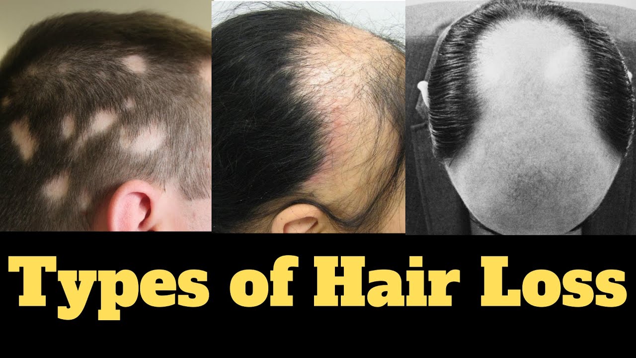 Different Forms of Hair Loss - YouTube