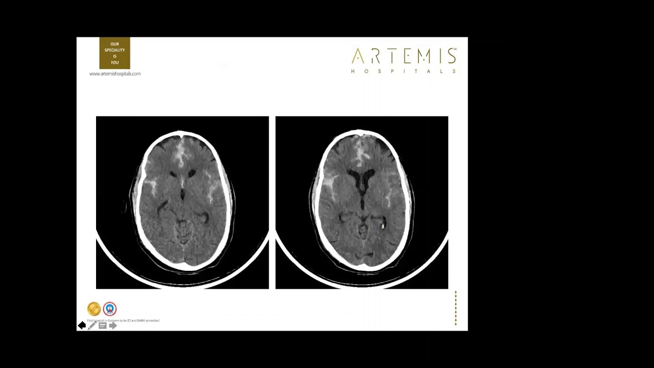 SAH: Critical care management - YouTube