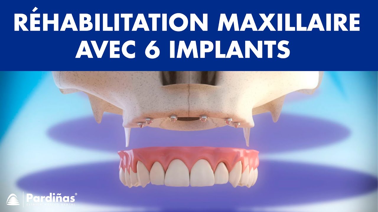 Réhabilitation du maxillaire avec 6 implants dentaires © - YouTube