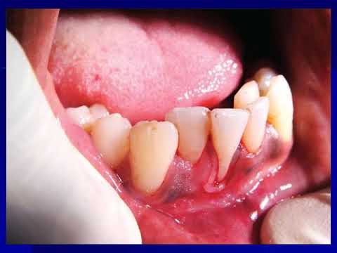 MUCOGINGIVAL PROBLEMS 2 vidio - YouTube