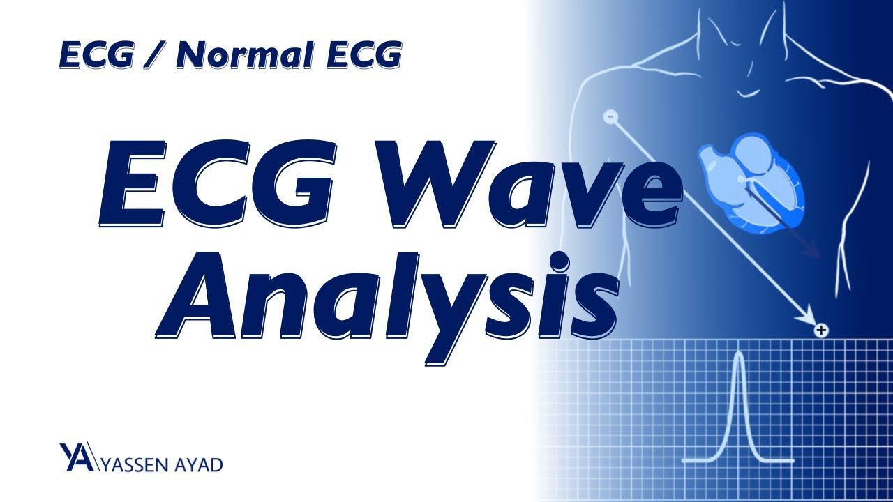 ECG8 | ECG wave analysis - YouTube