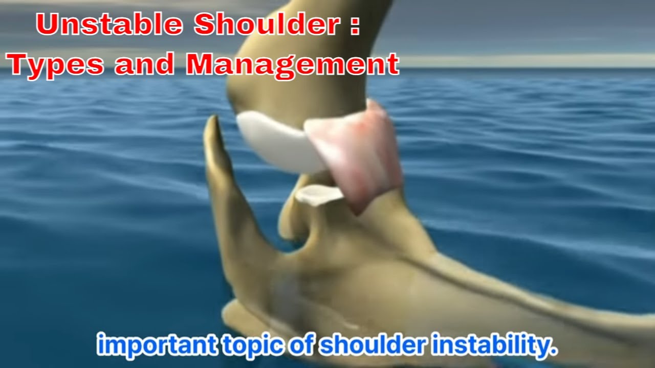 Mastering Shoulder Instability: The Ultimate Guide To Types And ...