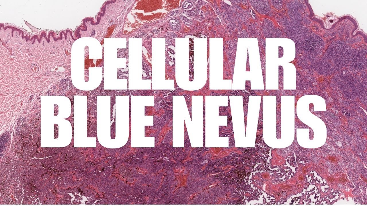 Cellular Blue Nevus - YouTube