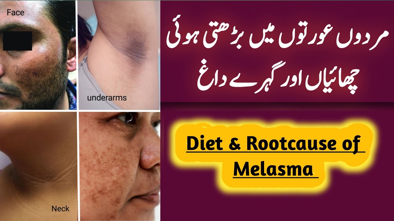 How To Treat Hyperpigmentation Dark Patches On Face Dark Underarms how-to-treat-hyperpigmentation-dark-patches-on-face-dark-underarms