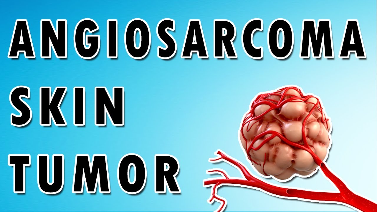 Angiosarcoma Symptoms, Treatment, and Causes - YouTube