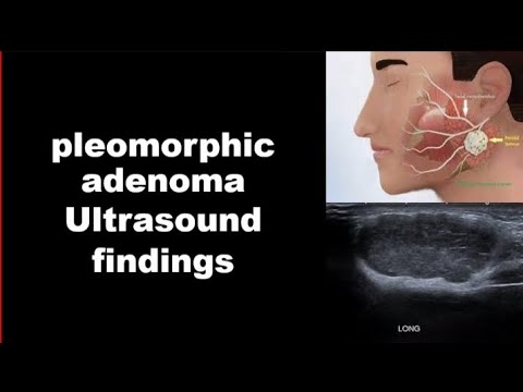 pleomorphic adenoma ultrasound findings - YouTube