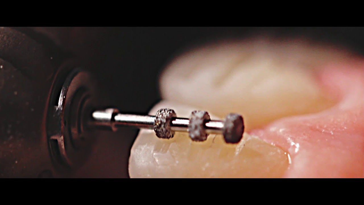 Tip about preps: follow the 3 planes of the tooth - YouTube