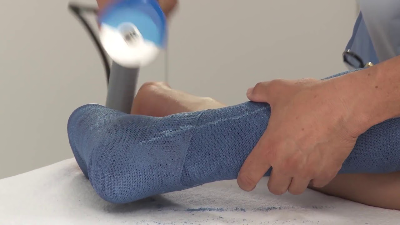 Synthetic Lower Leg Cast Removal - Astir - YouTube