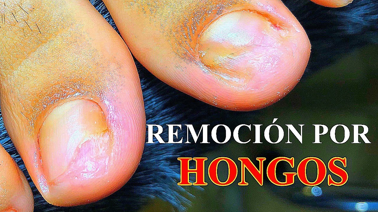 REMOCION DE UÑAS INFECTADAS POR HONGOS (ONICOMICOSIS). - YouTube