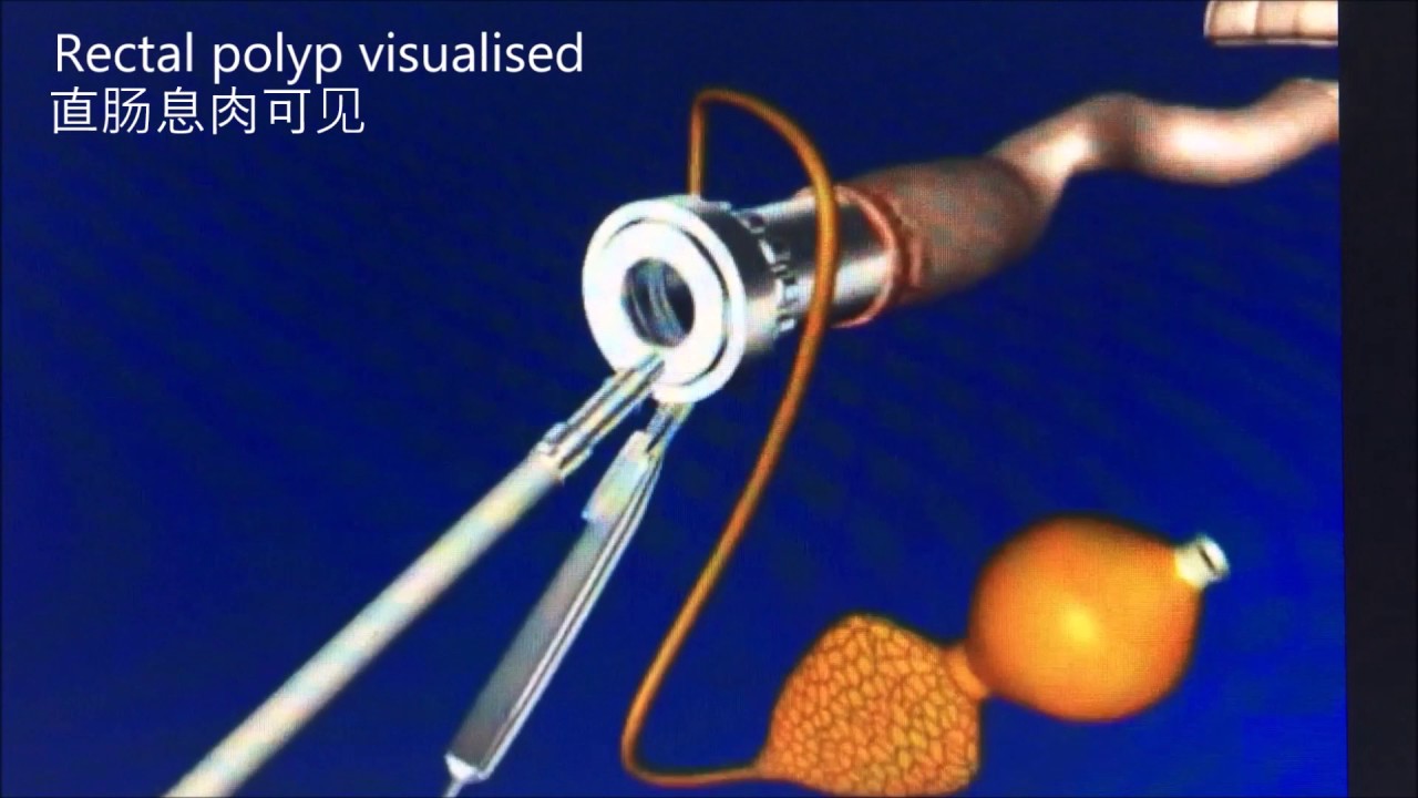 Transanal Endoscopic Micro-Surgery (TEMS) - Chinese Simplified - YouTube