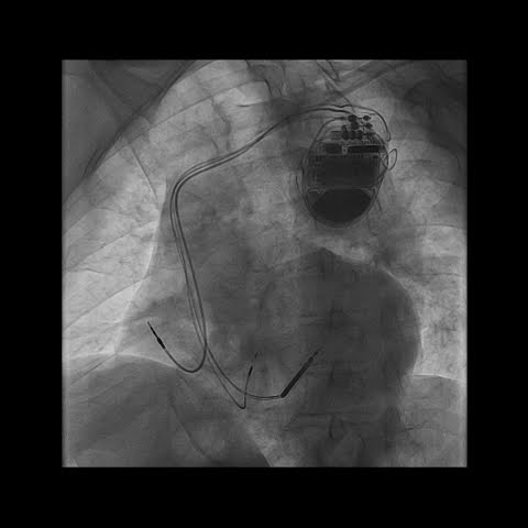 His-bundle pacing #pacing #his #csp #hisbundle #pacemaker # ...