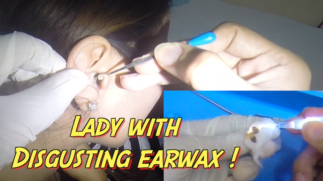 Disgusting Earwax Removal in a Lady! - YouTube
