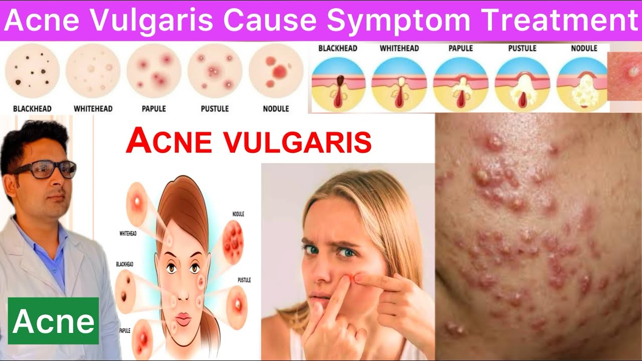 Acne Vulgaris Cause Symptom Diagnosis Treatment | Acne Vulgaris | What ...