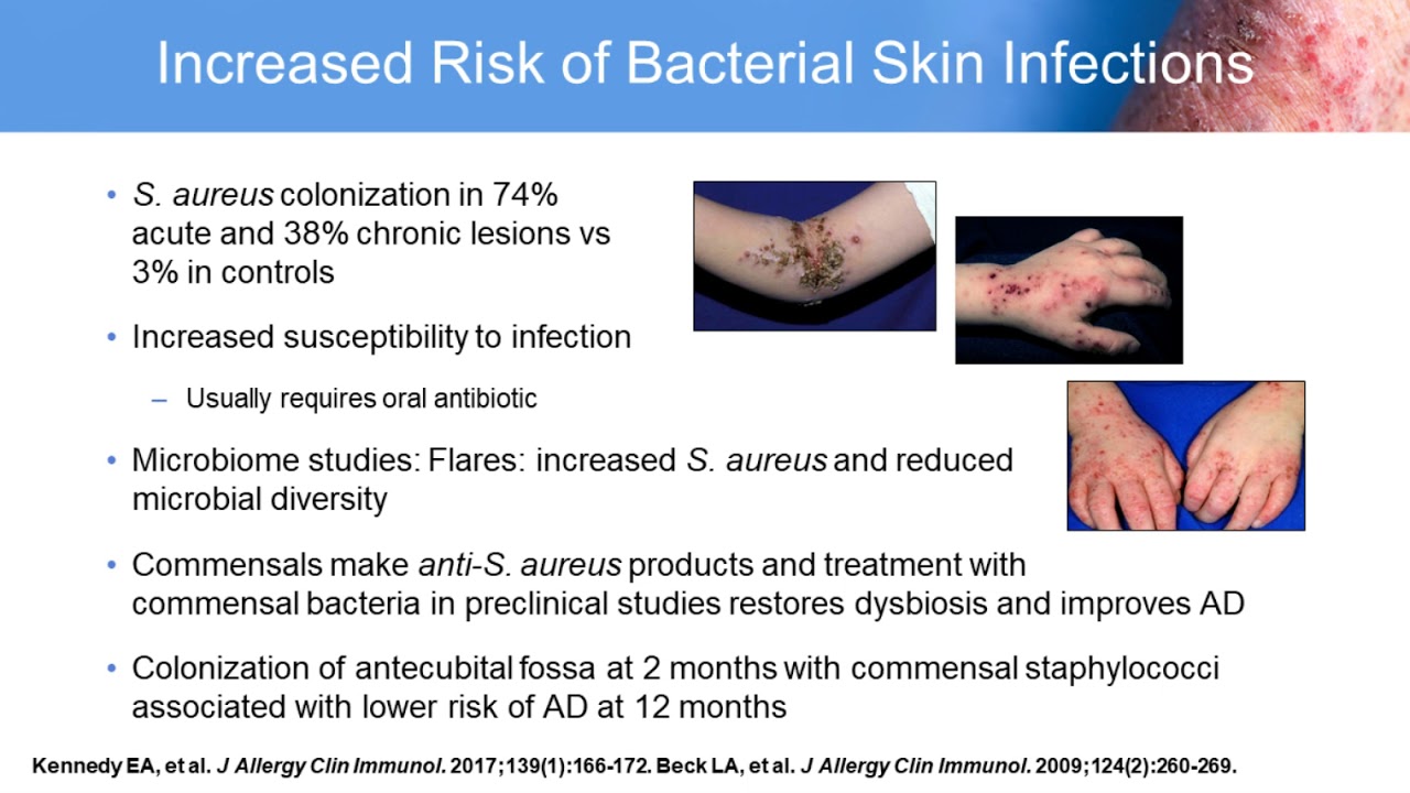 Atopic Dermatitis: Strategies to Improve Outcomes (Ages 2-5: Mild ...