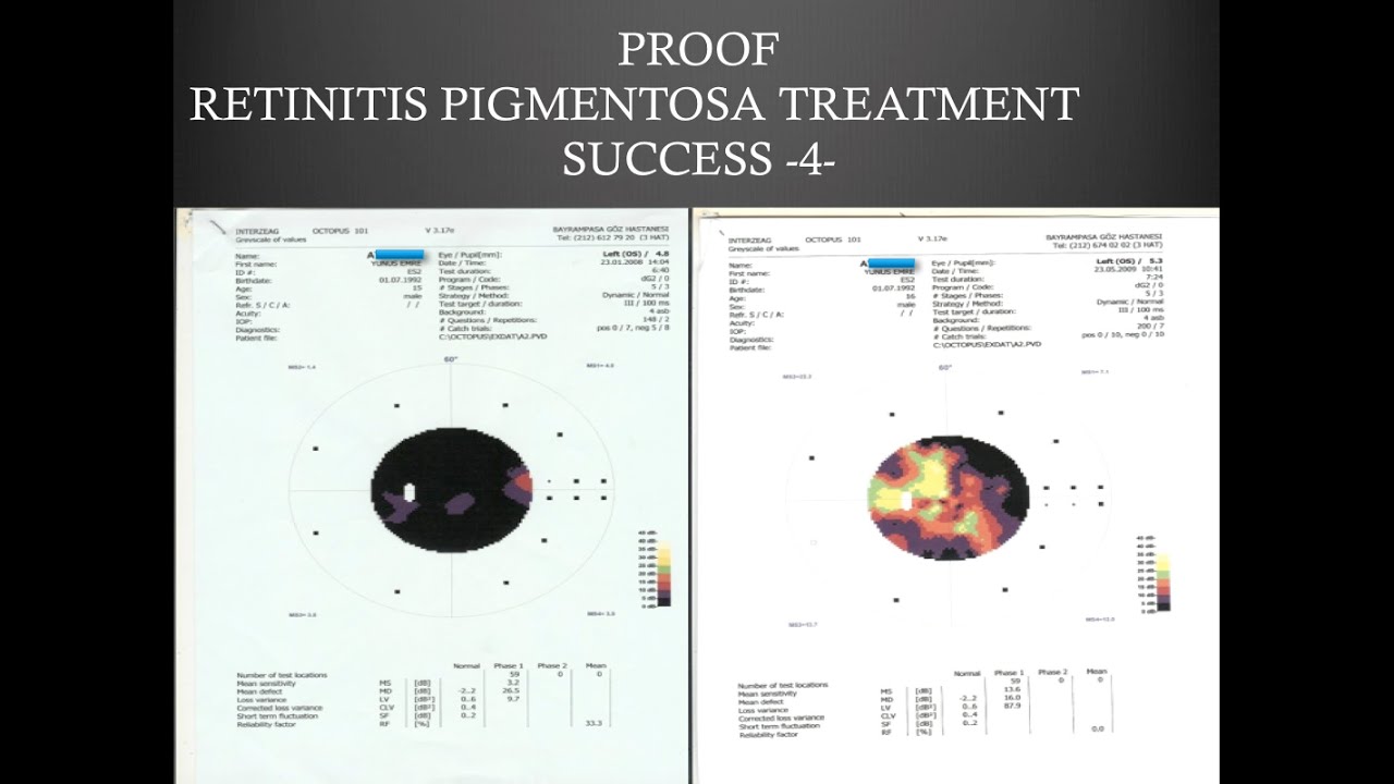 Visual Field Test Results 4 Medical Evidence Of Retinitis Pigmentosa visual-field-test-results-4-medical-evidence-of-retinitis-pigmentosa