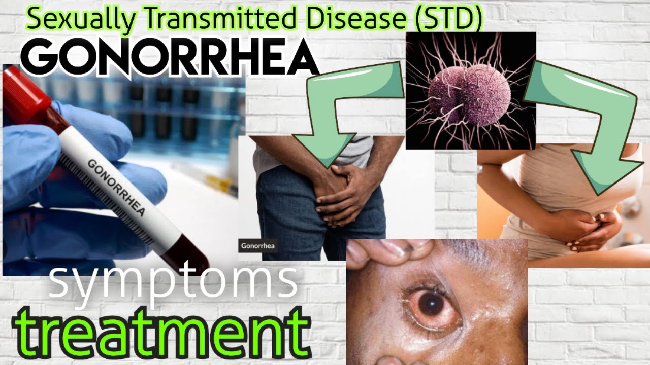 Gonorrhea - a Sexually Transmitted Disease (STD). Mayron kaba nito ...
