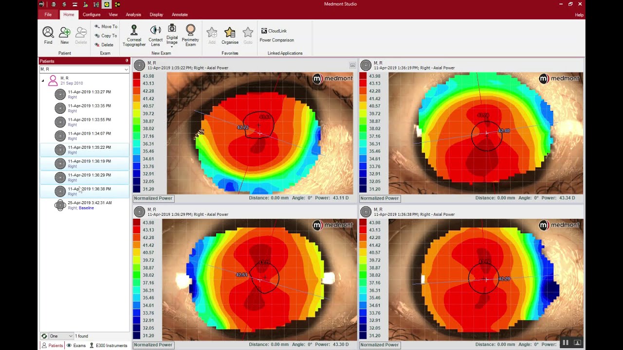 Medmont Meridia | Pre-fitting Orthokeratology Analysis - YouTube