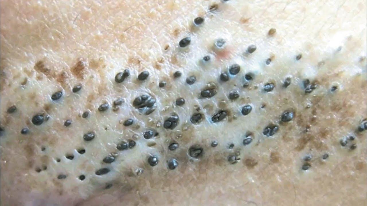 How to remove blackheads on face - YouTube