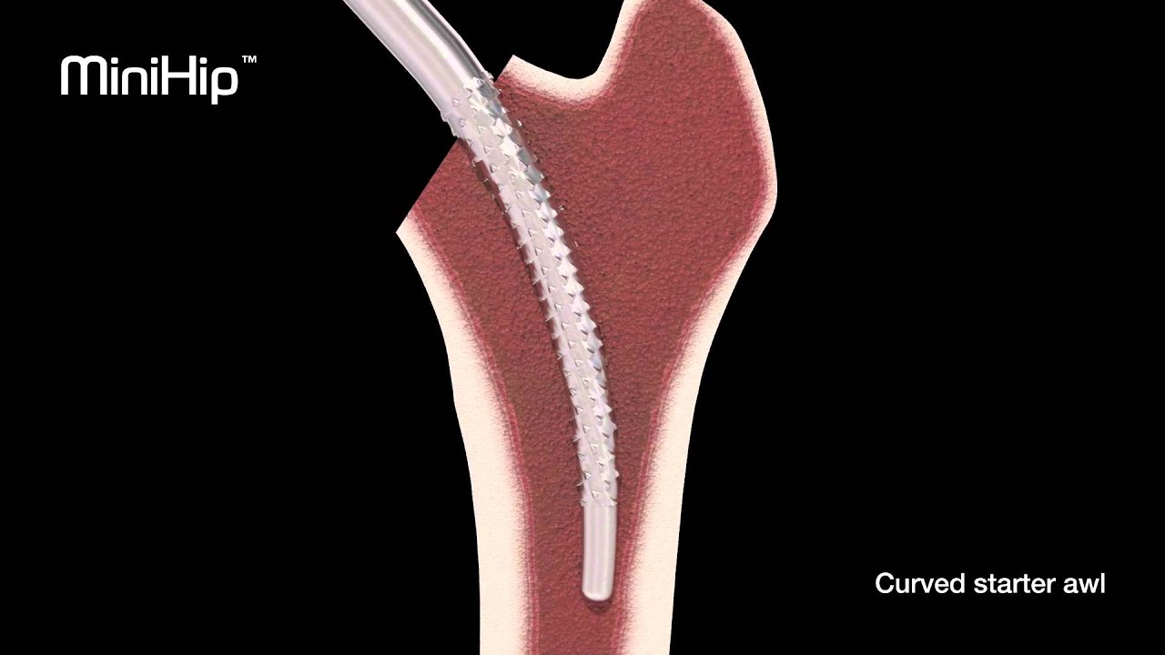 MiniHip™ - Surgical Technique (MKII Instrumentation) - YouTube