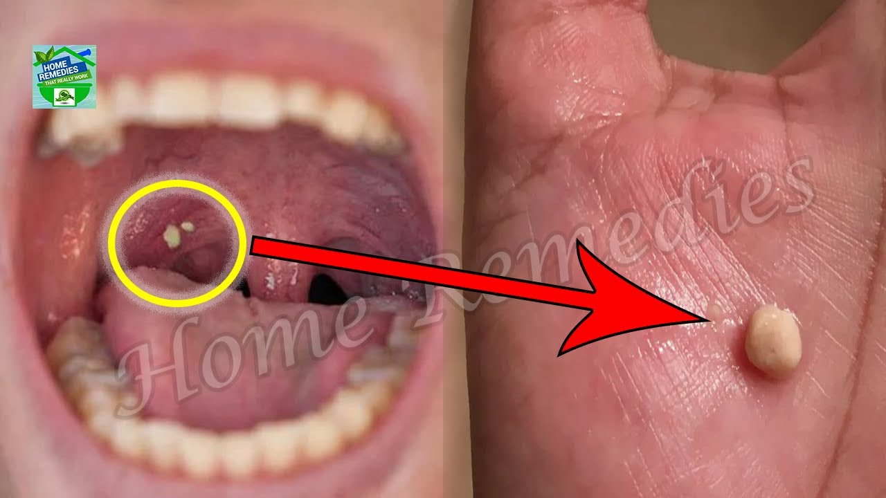3 Powerful Home Remedies for Tonsil Stones That Work Super Fast ...