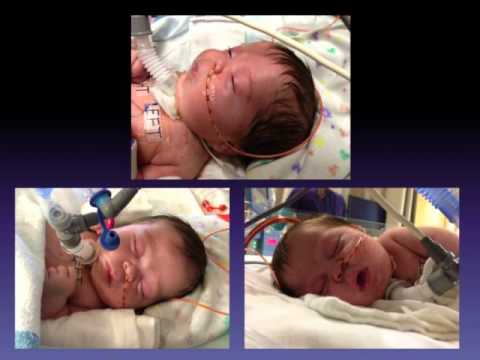 The Beginning Video Campomelic Dysplasia - YouTube