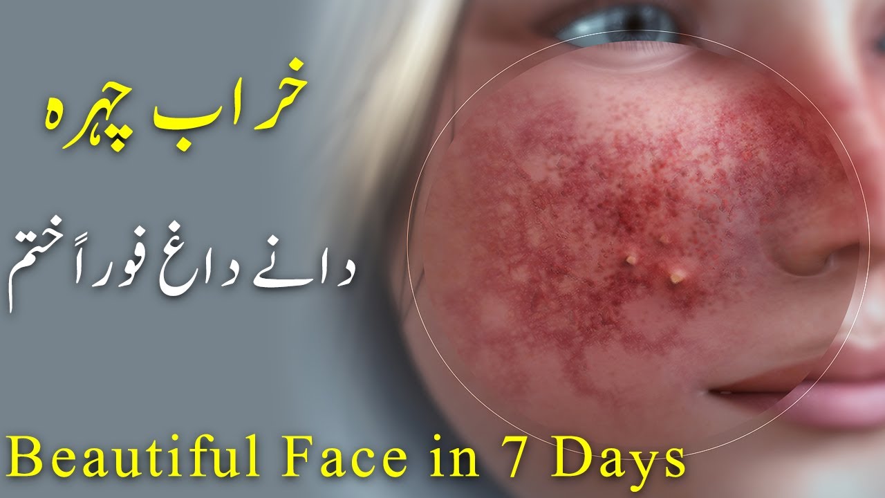 Kharab Chehra Dany Dagh Foran Khatam Beautiful Face in 7 Days - YouTube