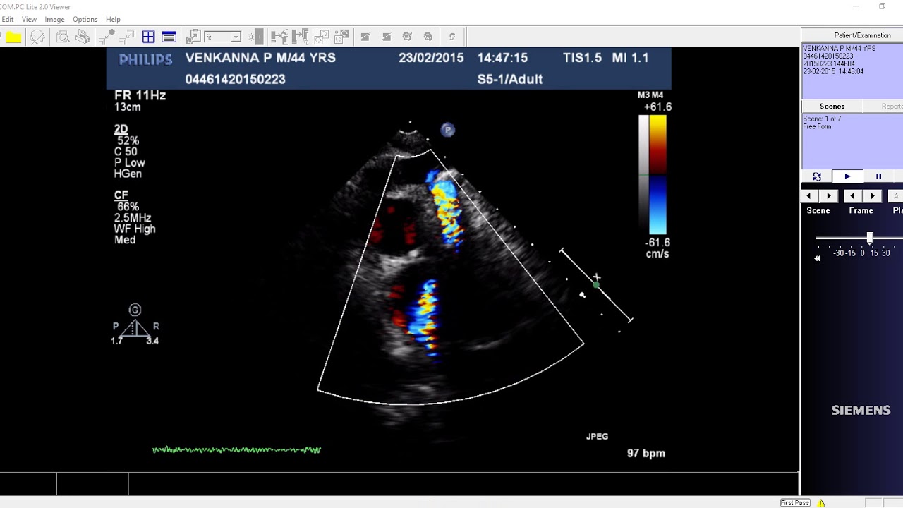 classic BT shunt ( BTS) ECHO - YouTube