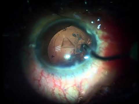 Management of Descemet Membrane Detachment In a Case With Traumatic ...