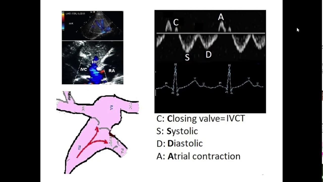 Answer To Question 15 Hepatic Vein Doppler Interpretation Youtube