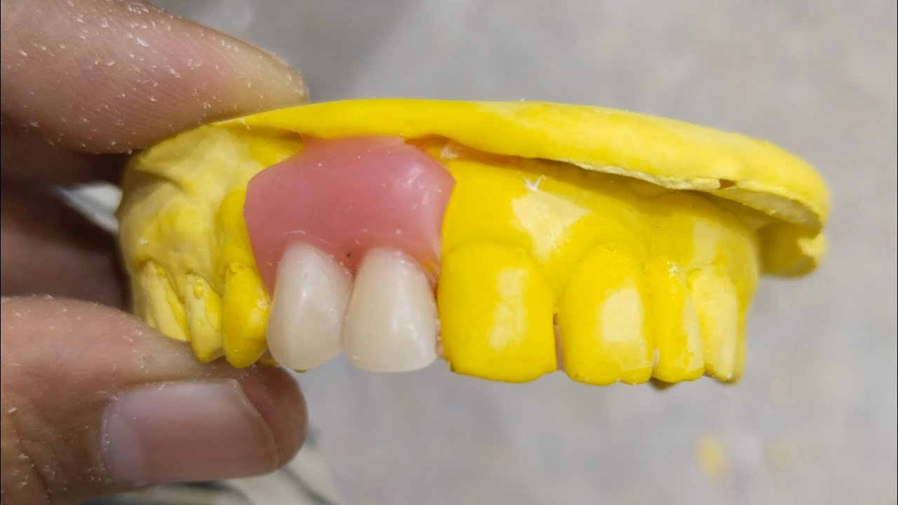 Flexible Removable Partial Denture Trail By Haider...#Dentur - YouTube
