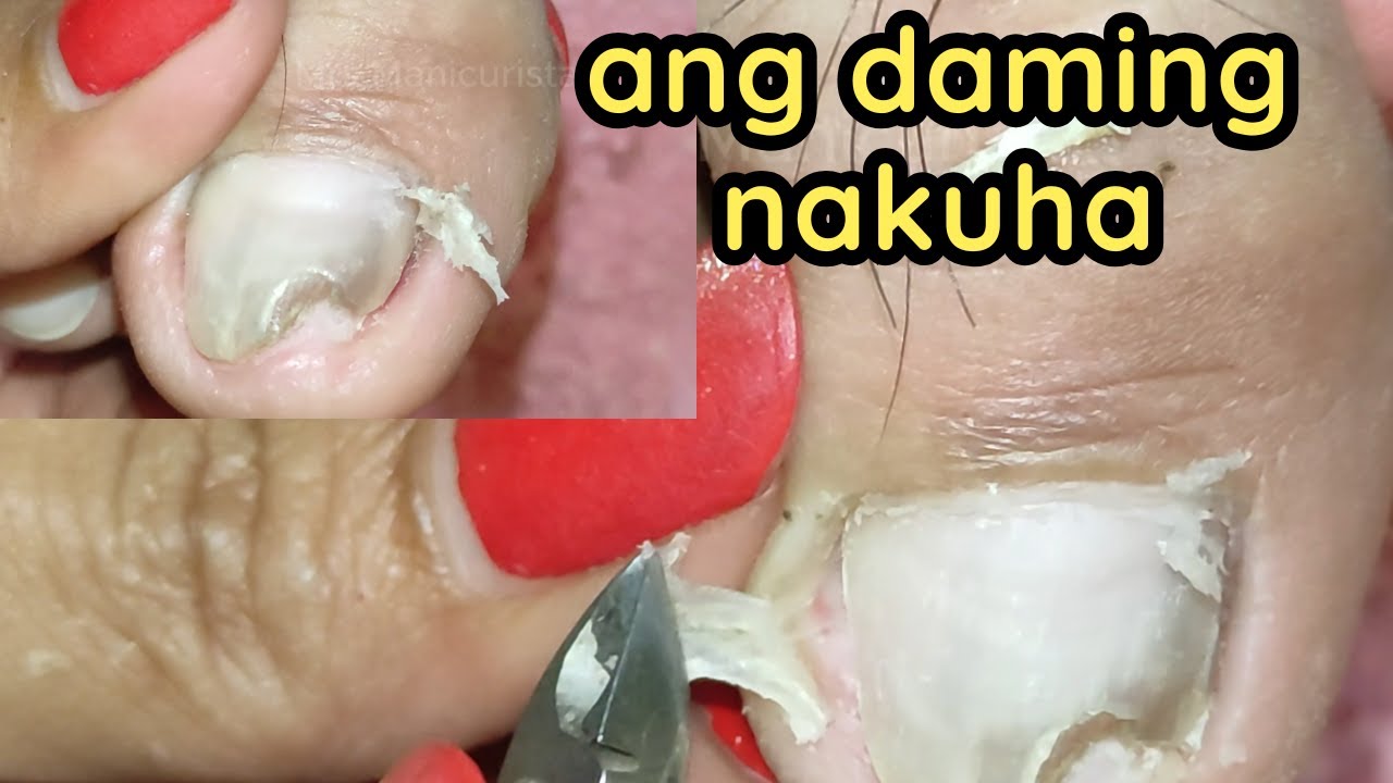 Sulit ang daming nakuha sa paa ni client - YouTube